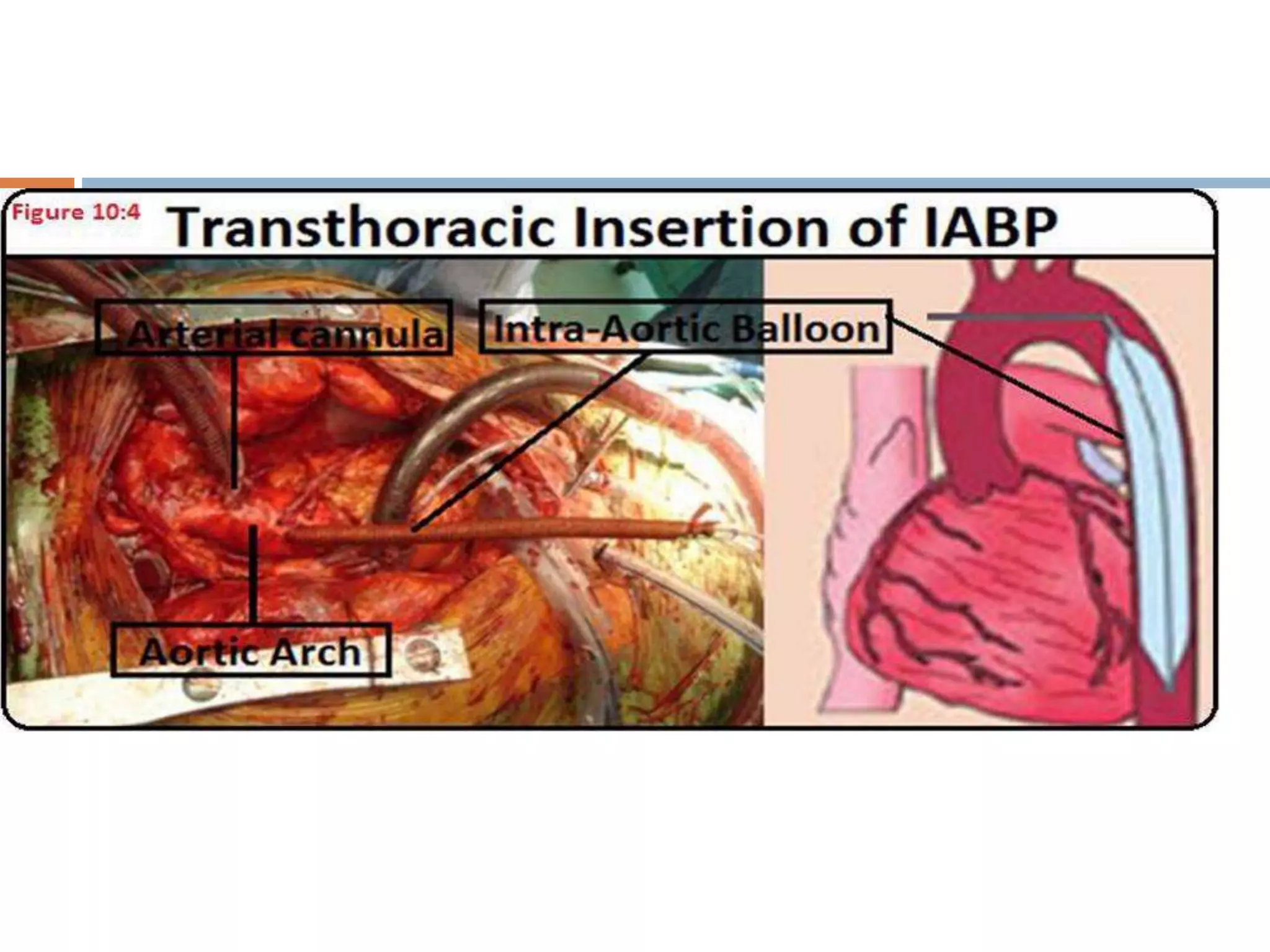 IABP- intra Aortic Balloon Pump | PPTX