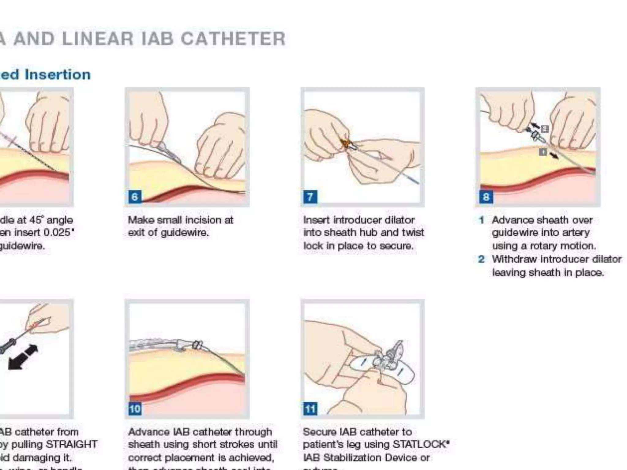IABP- intra Aortic Balloon Pump | PPTX