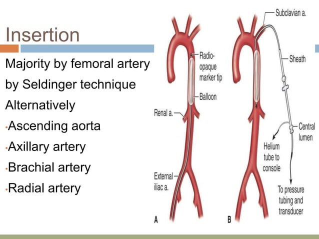 IABP- intra Aortic Balloon Pump | PPTX