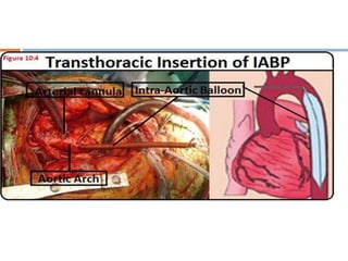 IABP- intra Aortic Balloon Pump | PPTX