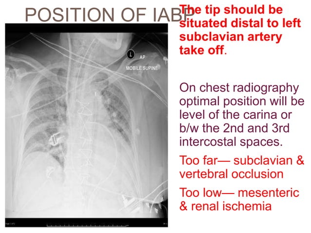 IABP- intra Aortic Balloon Pump | PPTX