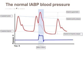 IABP- intra Aortic Balloon Pump | PPTX