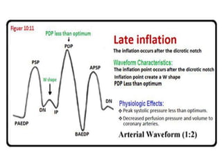 IABP- intra Aortic Balloon Pump | PPTX