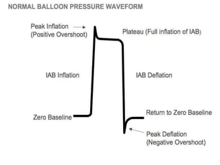 IABP- intra Aortic Balloon Pump | PPTX