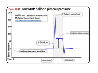 IABP- intra Aortic Balloon Pump | PPTX