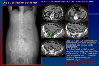SINDROME DE OBSTRUCCION INTESTINAL | PPT