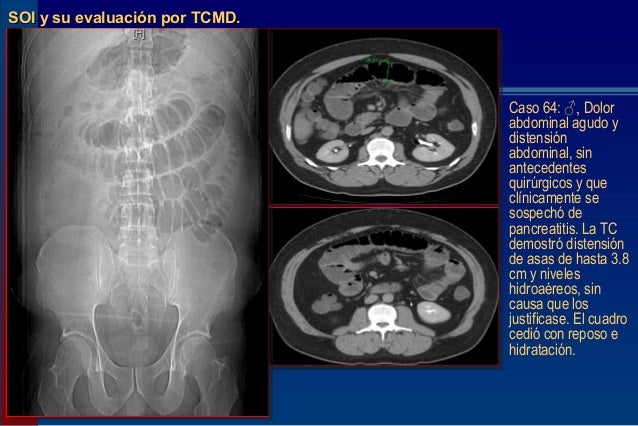 SINDROME DE OBSTRUCCION INTESTINAL