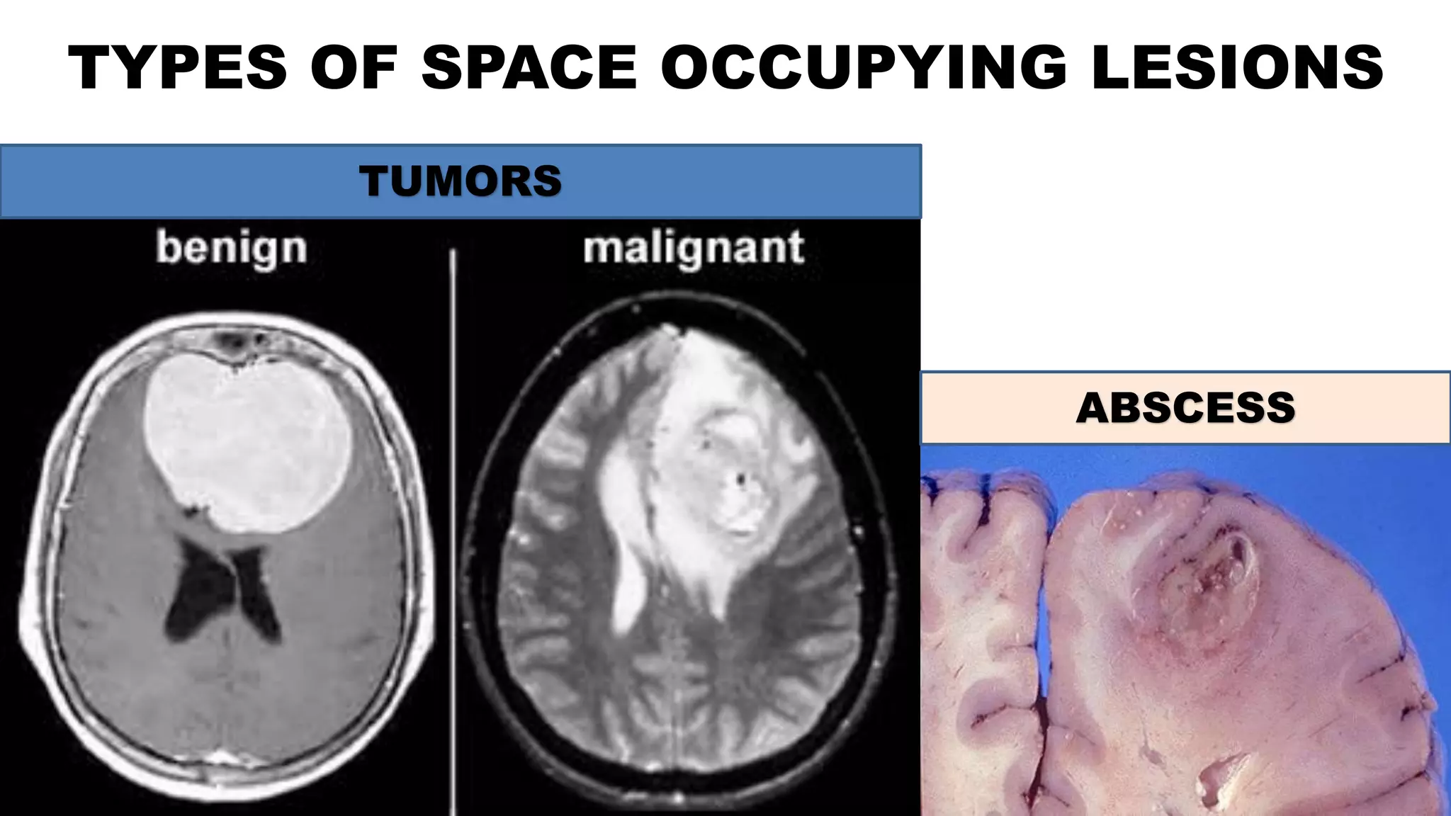 Space occupying lesions | PPTX