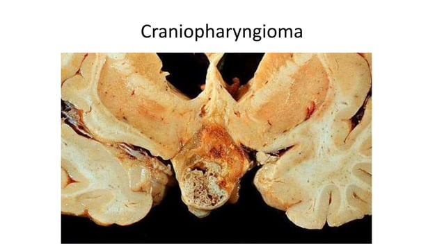 Space occupying lesions | PPTX