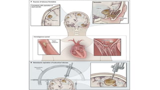 Space occupying lesions | PPTX
