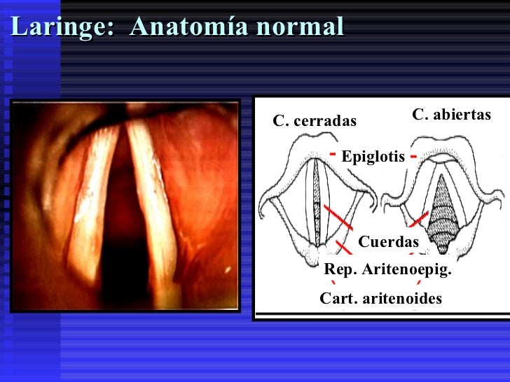 Sindrome obstructivo laringeo agudo