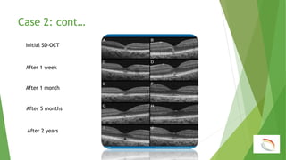 Solar Maculopathy Secondary to Sunlight Exposure Reflected From the ...