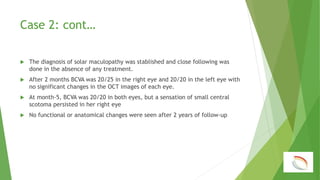 Solar Maculopathy Secondary to Sunlight Exposure Reflected From the ...