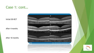 Solar Maculopathy Secondary to Sunlight Exposure Reflected From the ...