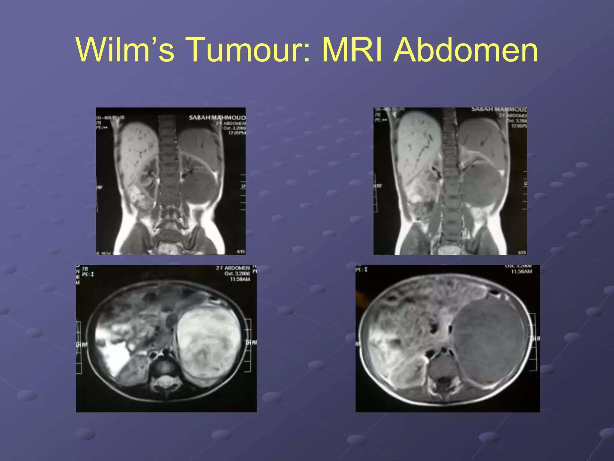 Solid and cystic pediatric abdominal tumors | PPT