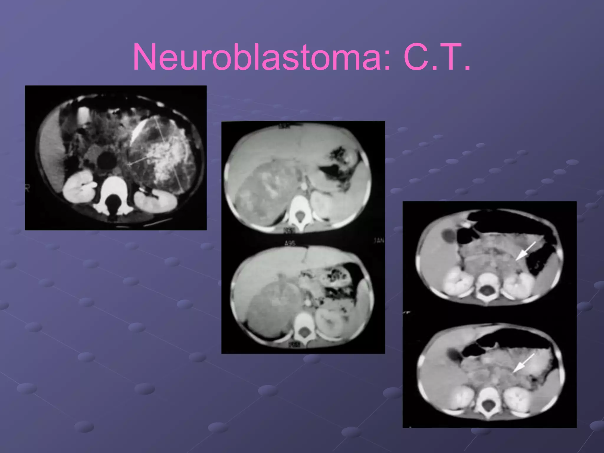 Solid and cystic pediatric abdominal tumors | PPT
