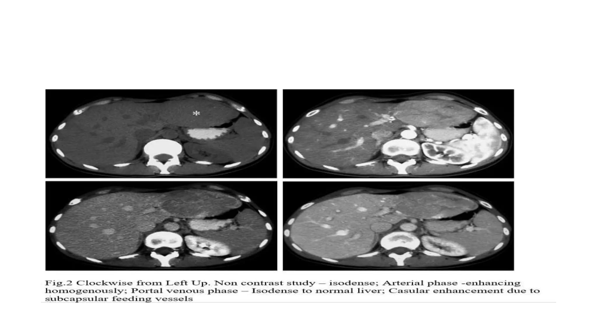 Solid liver SOL | PPTX