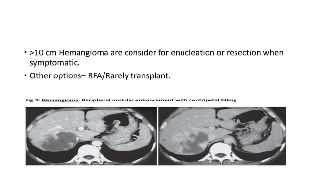 Solid liver SOL | PPTX