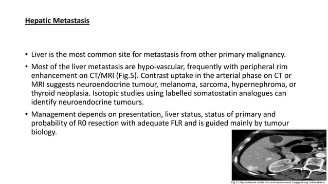 Solid liver SOL | PPTX
