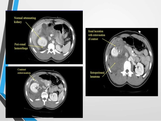 Solid organ injuries following abdominal trauma