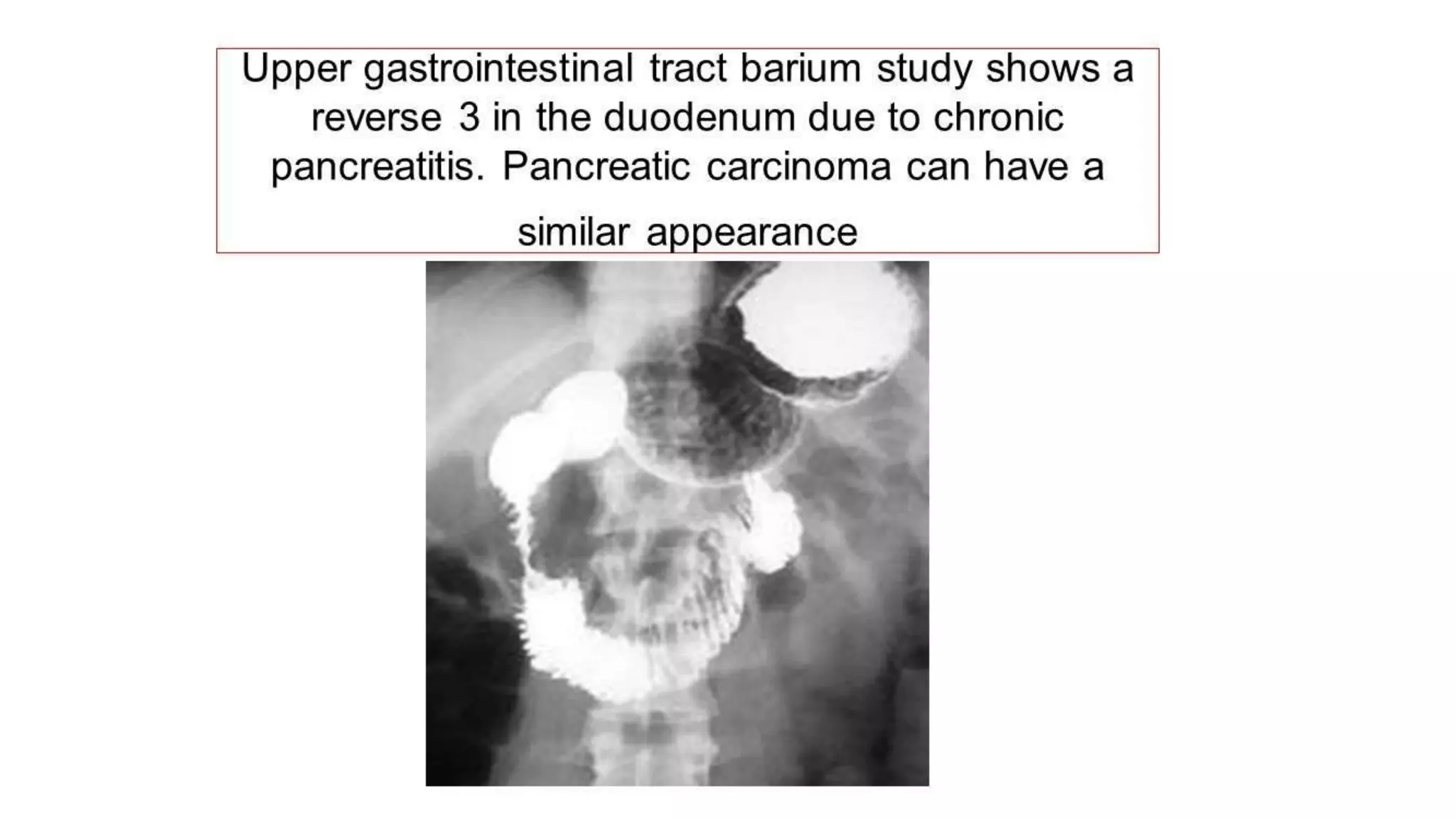 radiological imaging of pancreatic malignancy - solid neoplasms radiological imaging of exocrine ...