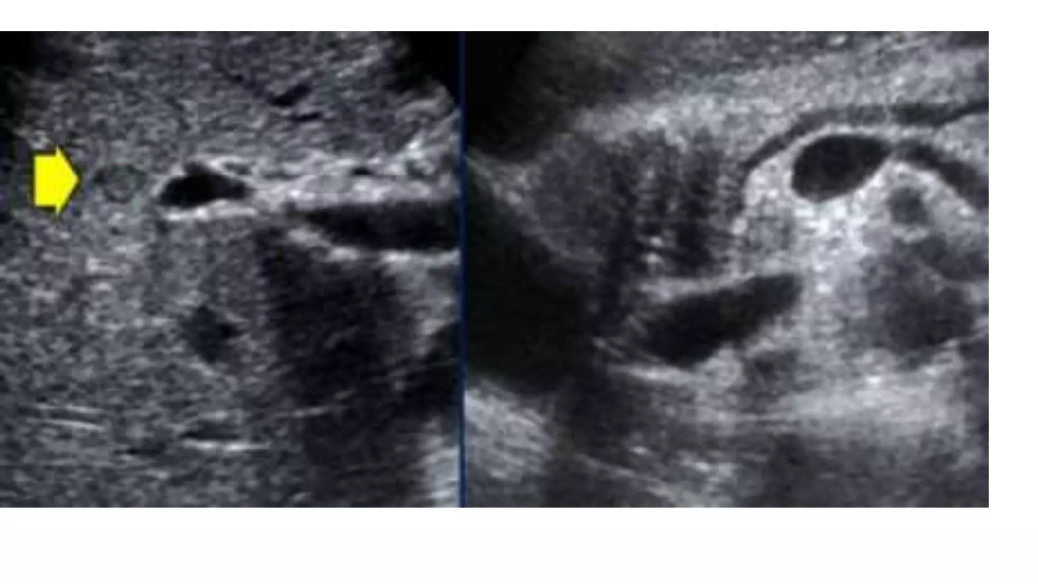 radiological imaging of pancreatic malignancy - solid neoplasms ...