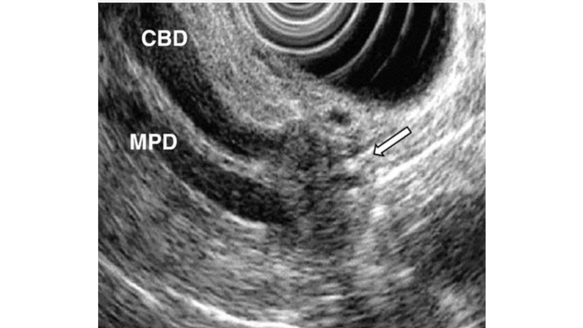radiological imaging of pancreatic malignancy - solid neoplasms radiological imaging of exocrine ...