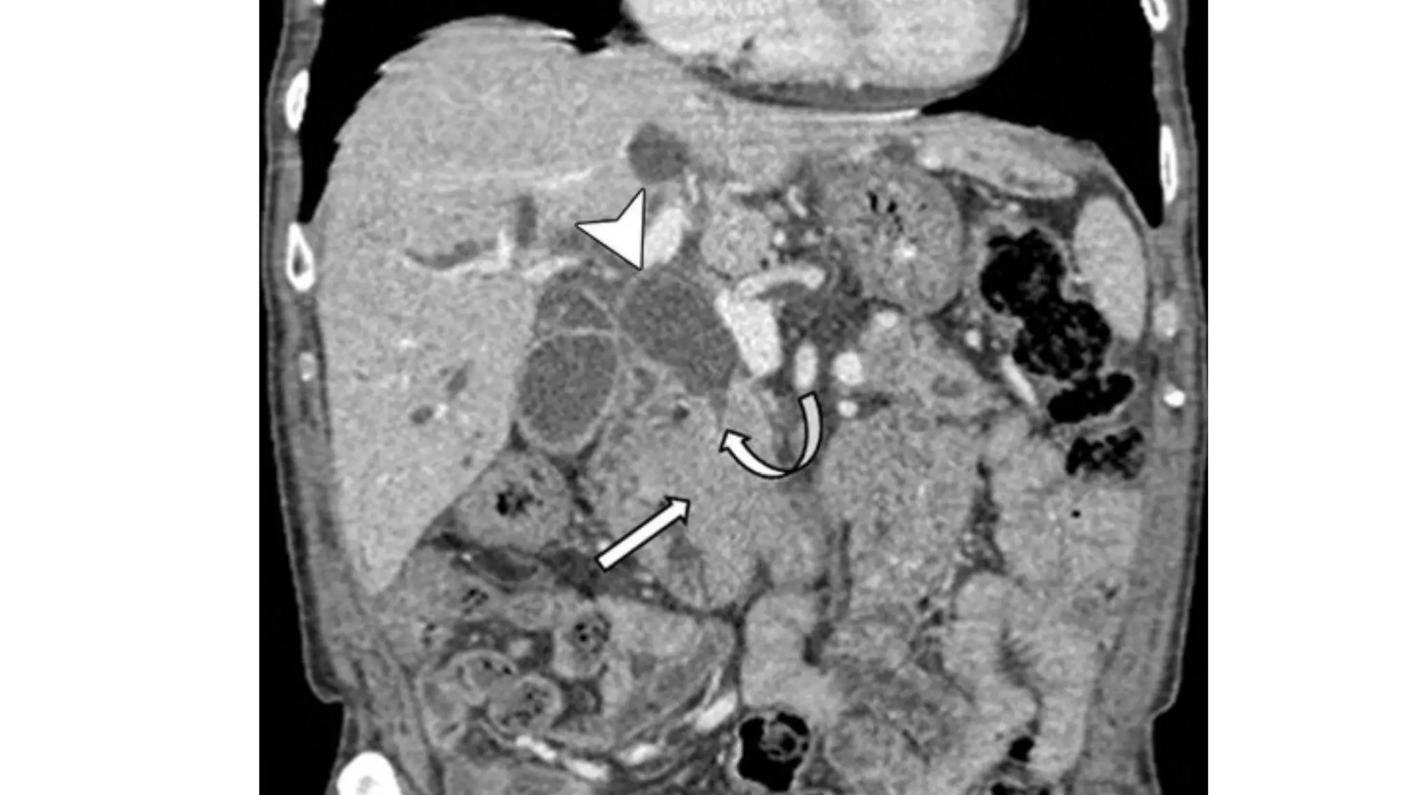 radiological imaging of pancreatic malignancy - solid neoplasms radiological imaging of exocrine ...