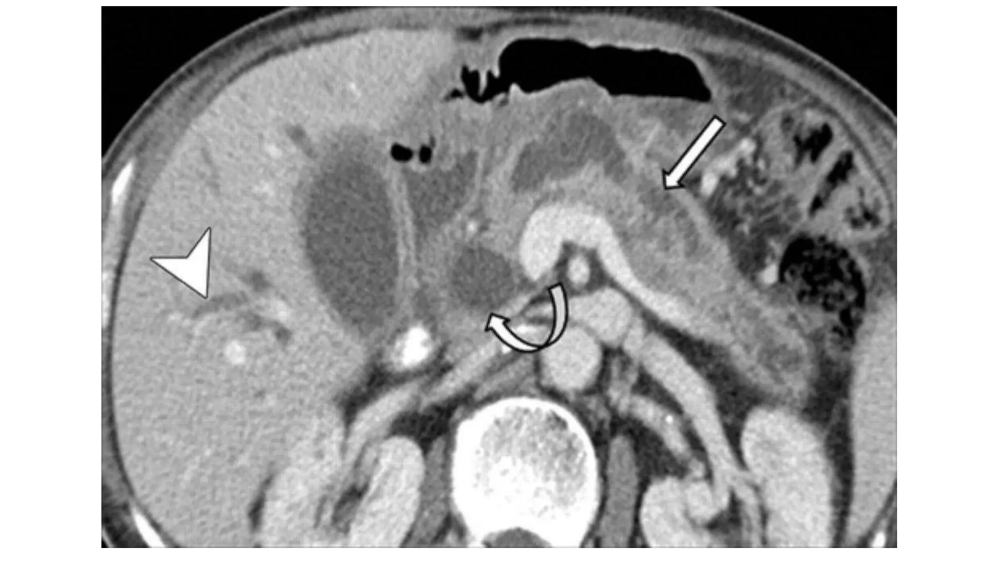 radiological imaging of pancreatic malignancy - solid neoplasms radiological imaging of exocrine ...
