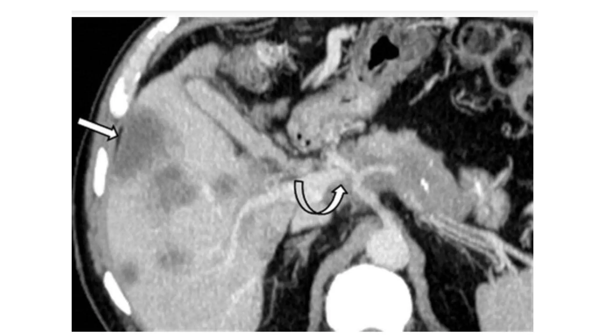 radiological imaging of pancreatic malignancy - solid neoplasms radiological imaging of exocrine ...