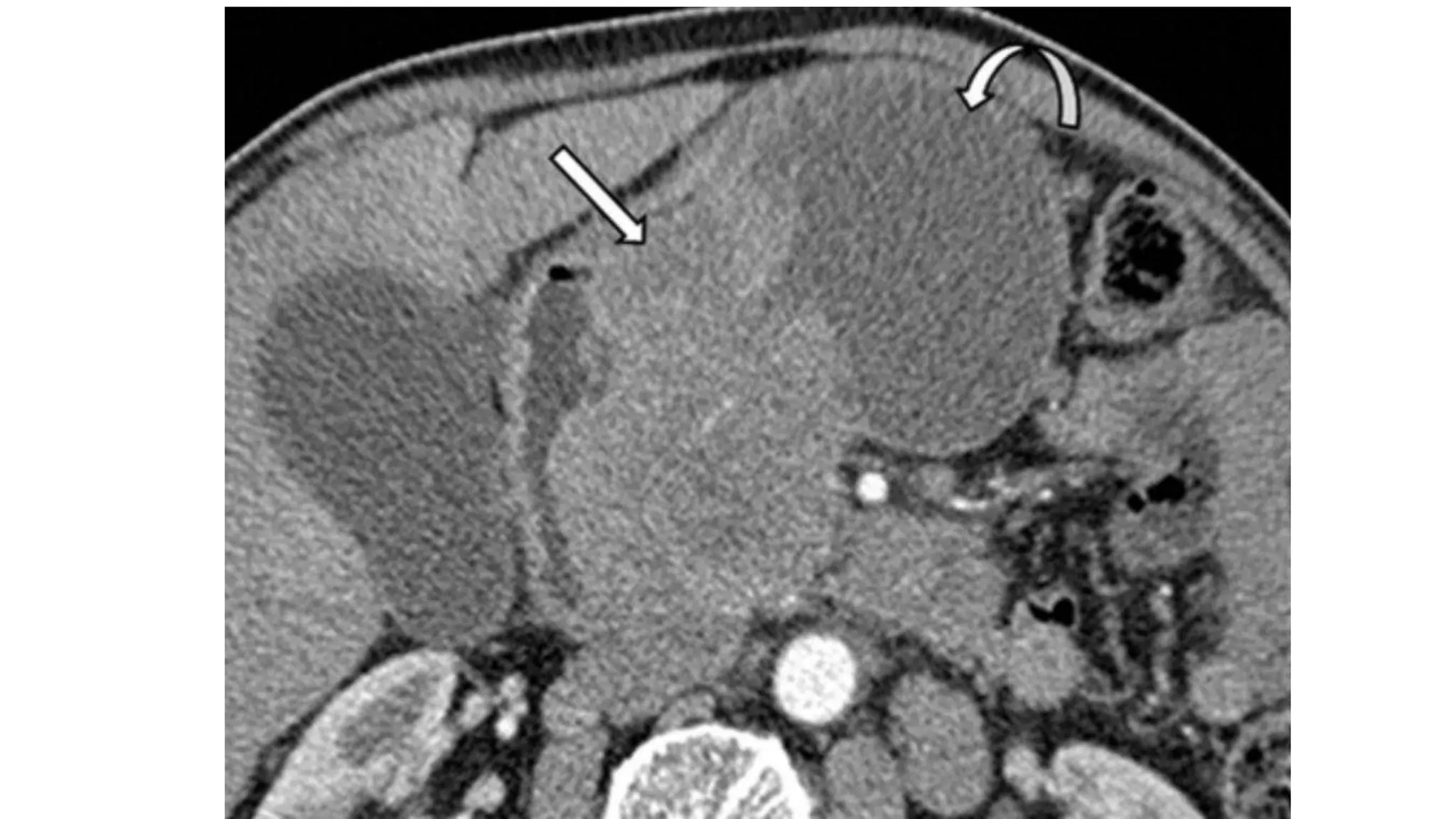 radiological imaging of pancreatic malignancy - solid neoplasms radiological imaging of exocrine ...