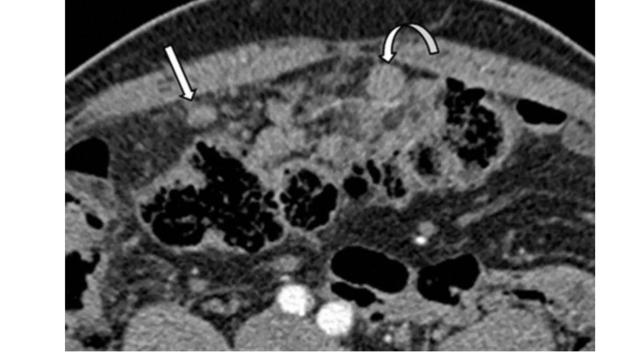 radiological imaging of pancreatic malignancy - solid neoplasms radiological imaging of exocrine ...