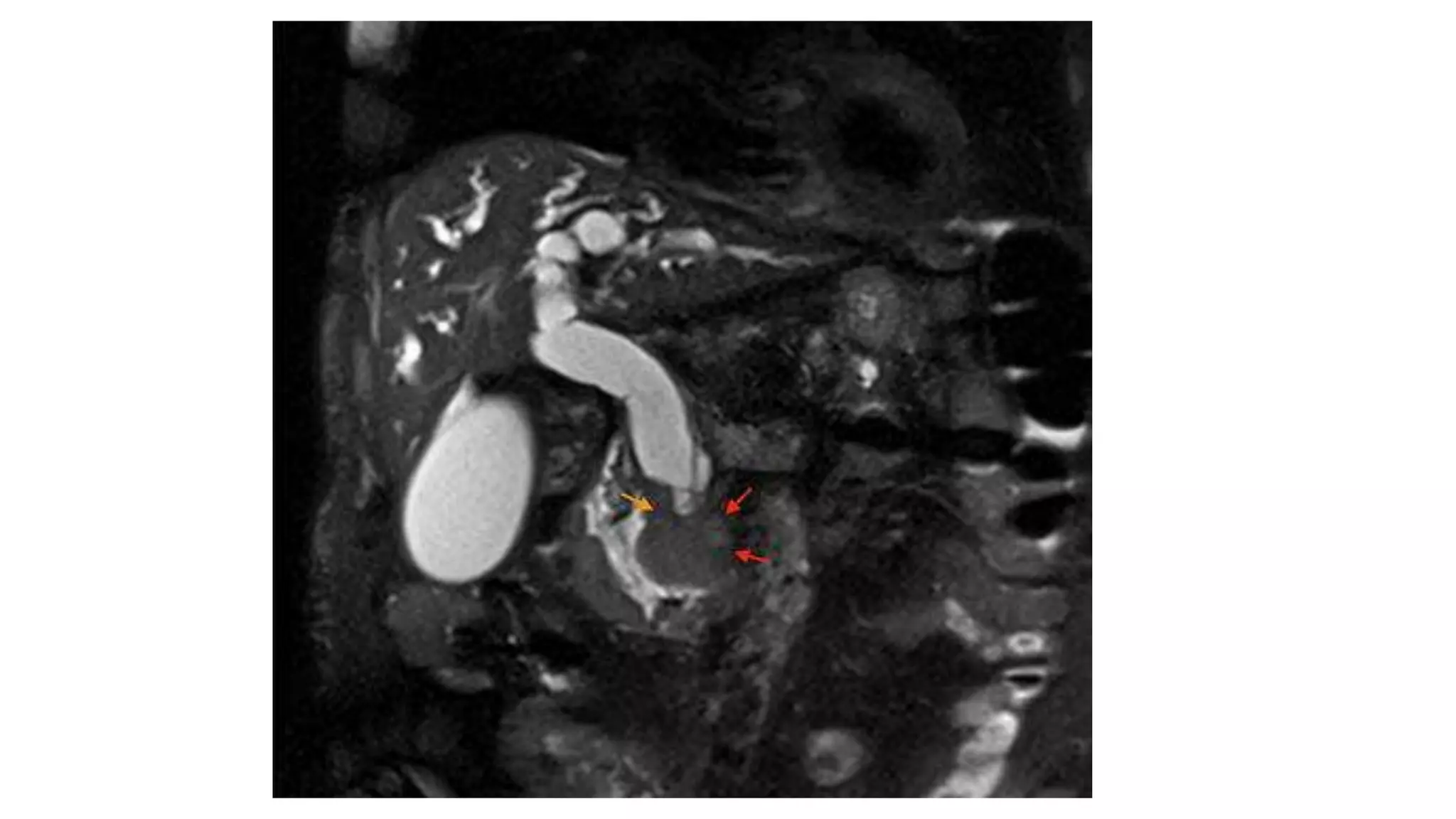 radiological imaging of pancreatic malignancy - solid neoplasms ...