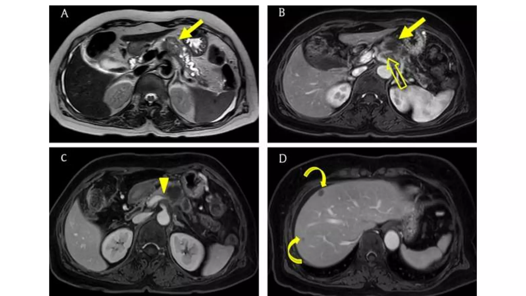 radiological imaging of pancreatic malignancy - solid neoplasms radiological imaging of exocrine ...