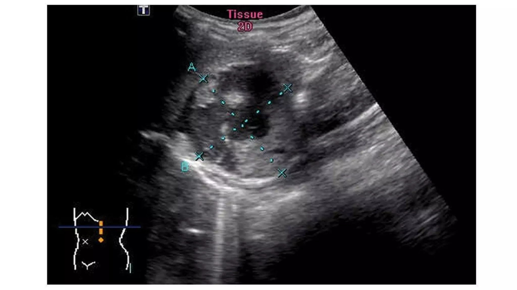 radiological imaging of pancreatic malignancy - solid neoplasms radiological imaging of exocrine ...