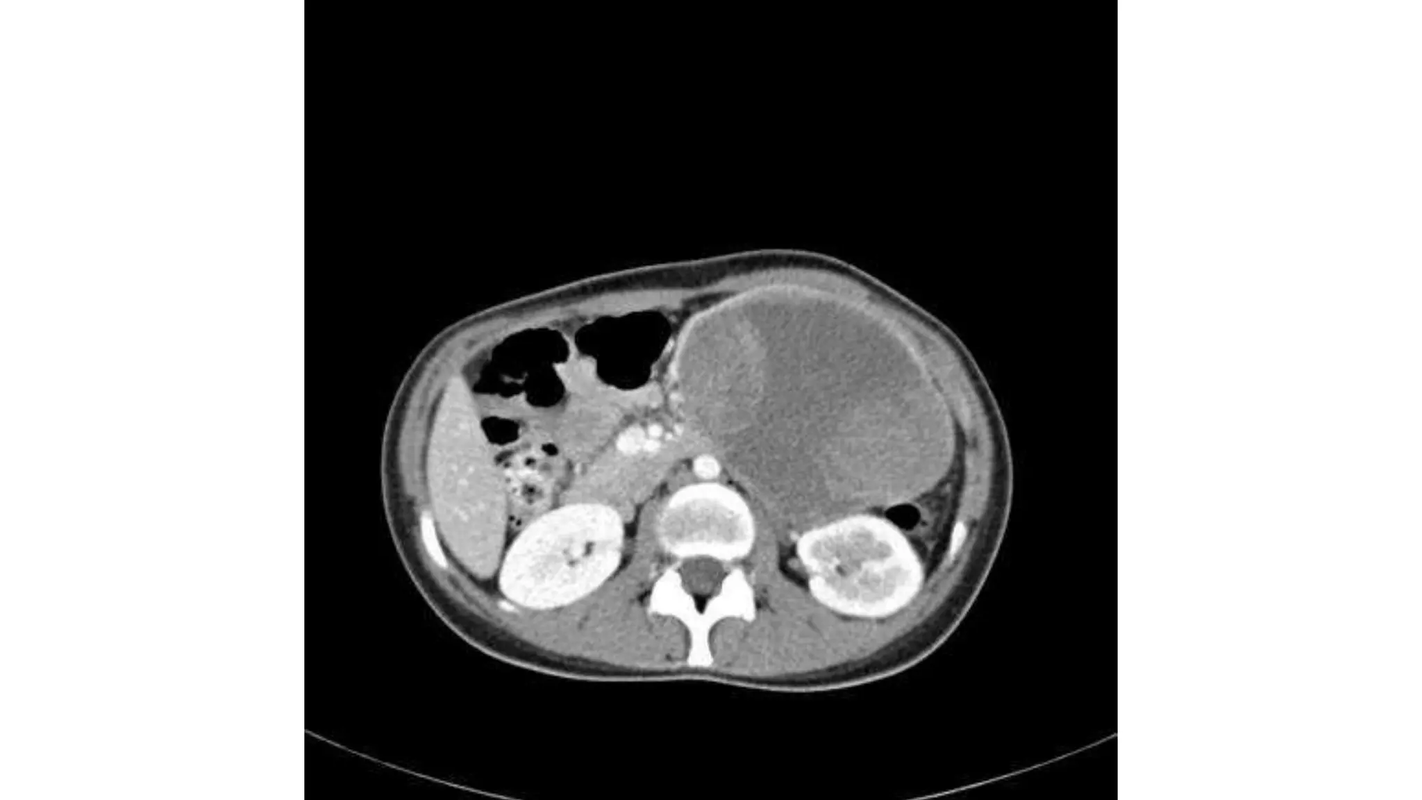 radiological imaging of pancreatic malignancy - solid neoplasms radiological imaging of exocrine ...