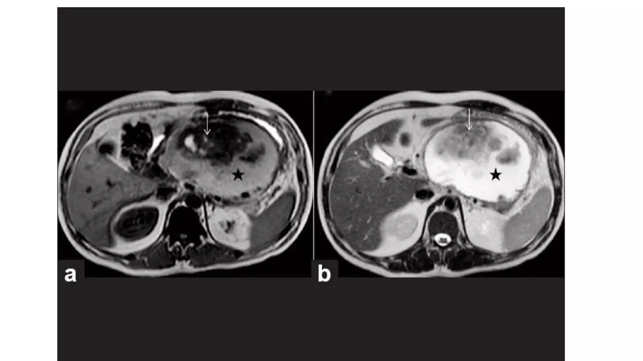 radiological imaging of pancreatic malignancy - solid neoplasms radiological imaging of exocrine ...