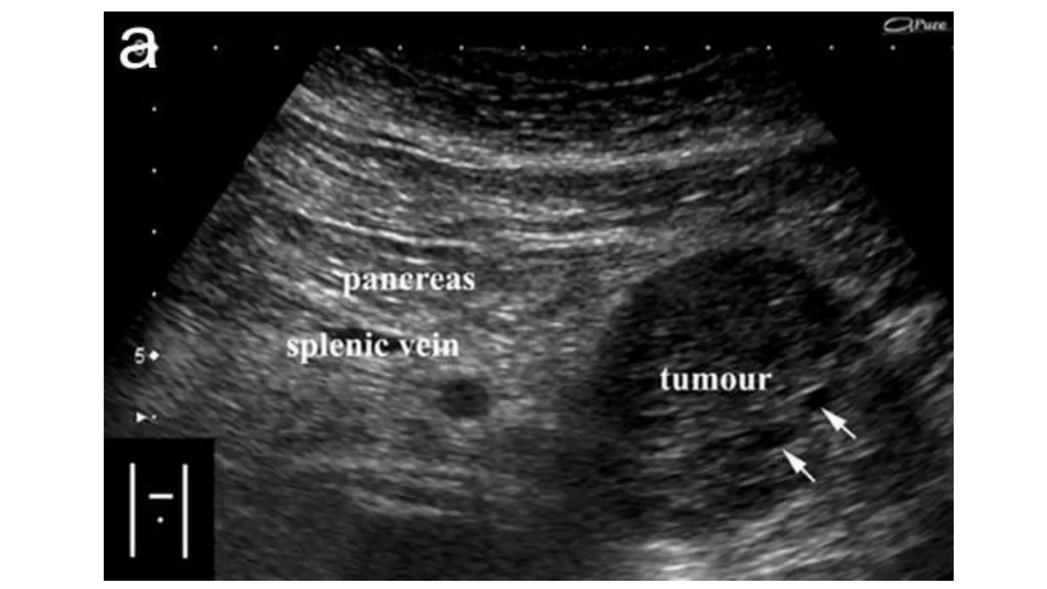 radiological imaging of pancreatic malignancy - solid neoplasms radiological imaging of exocrine ...