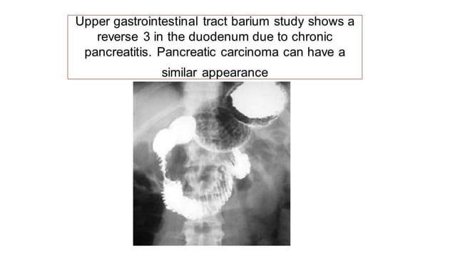 radiological imaging of pancreatic malignancy - solid neoplasms ...