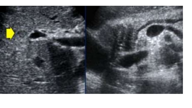 radiological imaging of pancreatic malignancy - solid neoplasms radiological imaging of exocrine ...