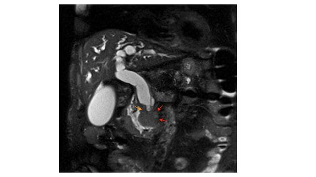 radiological imaging of pancreatic malignancy - solid neoplasms radiological imaging of exocrine ...