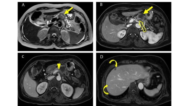 radiological imaging of pancreatic malignancy - solid neoplasms radiological imaging of exocrine ...