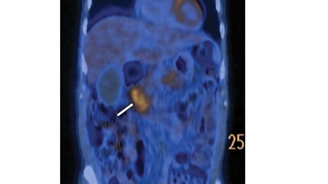 radiological imaging of pancreatic malignancy - solid neoplasms radiological imaging of exocrine ...