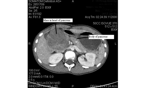 radiological imaging of pancreatic malignancy - solid neoplasms ...