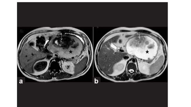 radiological imaging of pancreatic malignancy - solid neoplasms ...
