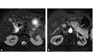 radiological imaging of pancreatic malignancy - solid neoplasms ...