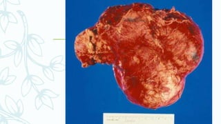 Solid tumors | PPTX