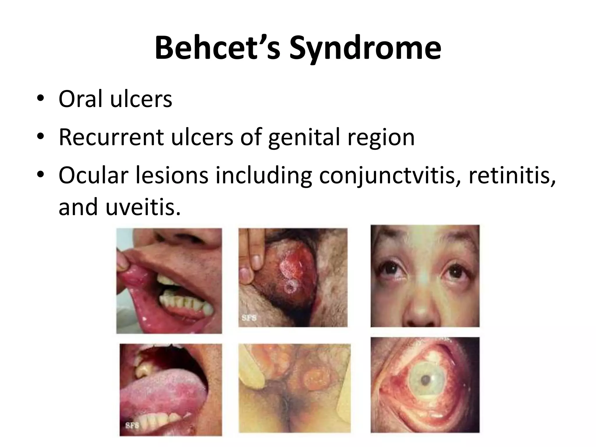 Solitary oral ulcers and systemic diseases | PPTX