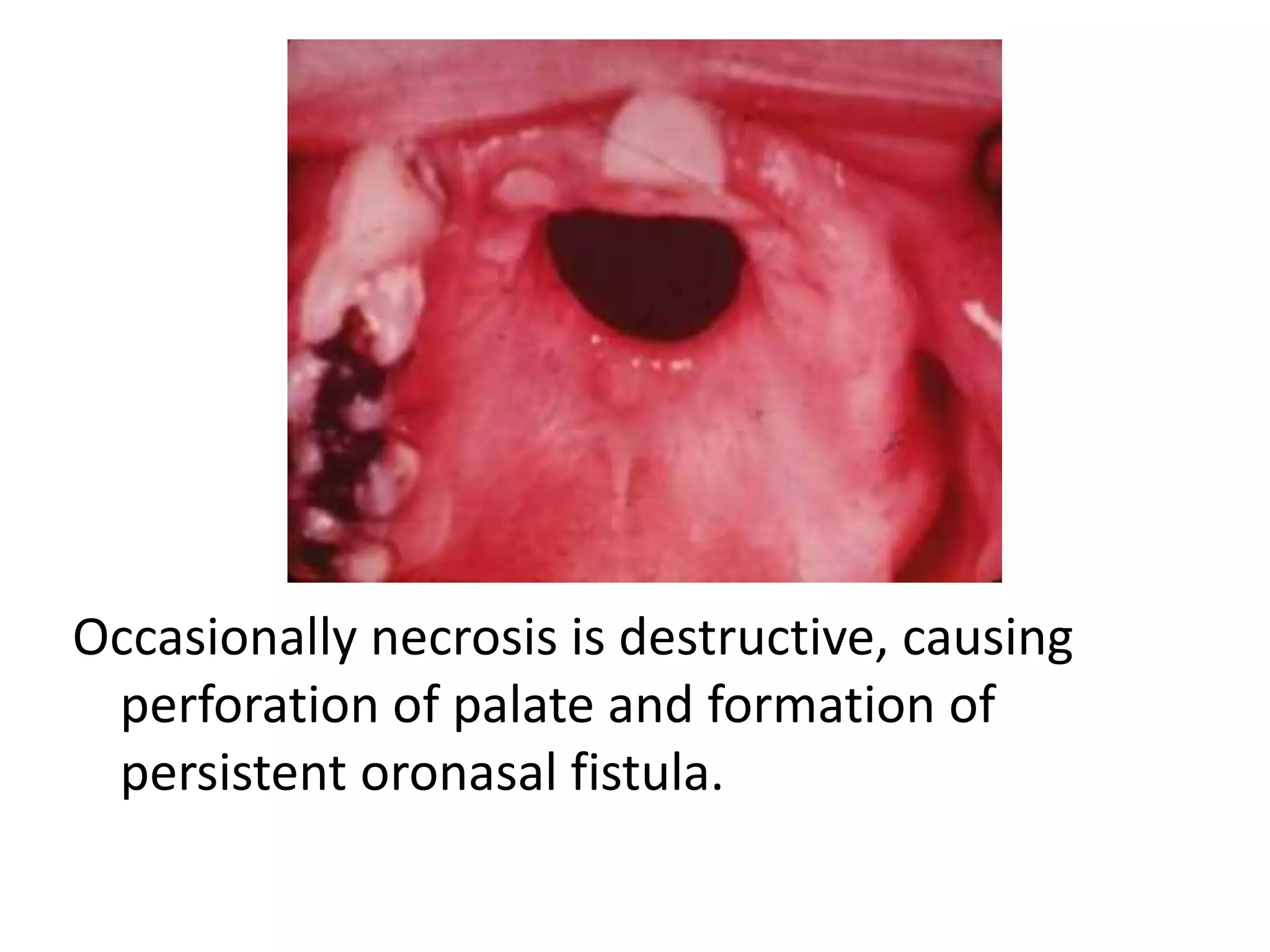 Solitary oral ulcers and systemic diseases | PPTX