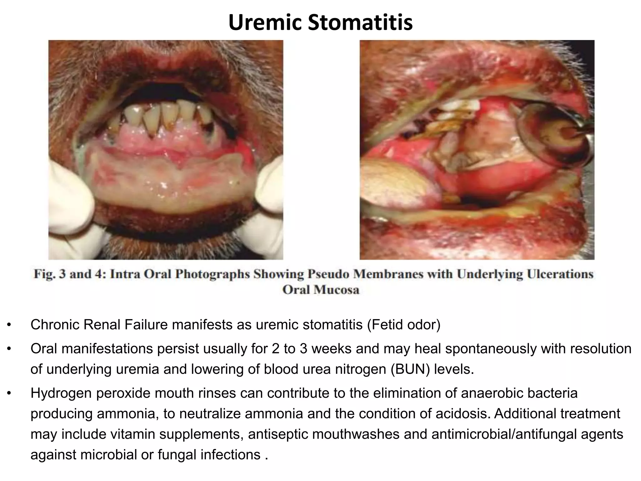 Solitary oral ulcers and systemic diseases | PPTX